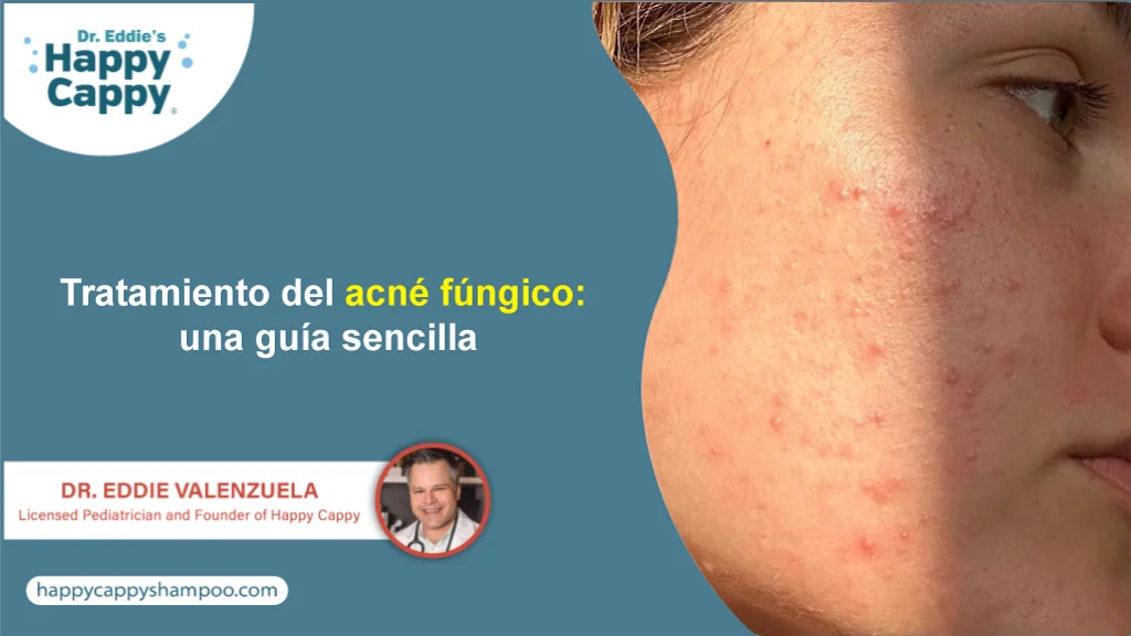 Los Mejores Nombres de Cremas para el Acné: Guía para Piel Limpia y Sana